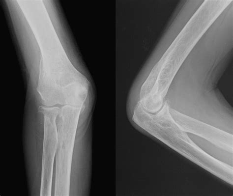 Chondrosarcoma