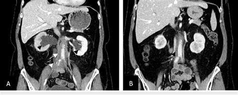 Coronal Ct Scan Slices Depicting Evolution Of Aortitis To Fibrosis A