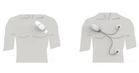 Infobionicai Announces Fda Clearance Of Its Mome Arc® Patch Ushering