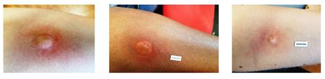 Examples Of The Mock Skin Indurations Produced Using Special Effects