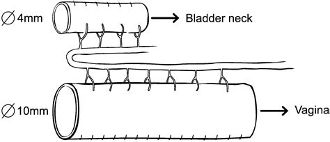 Urethroplasty And Vaginoplasty By A Single Small Bowel Interposition