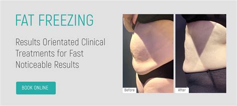 Fat Freezing The Temple Skincare And Spa