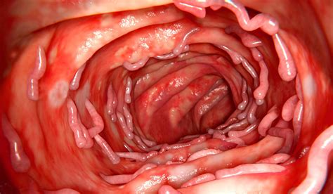 Ulcerative Colitis Uc No More