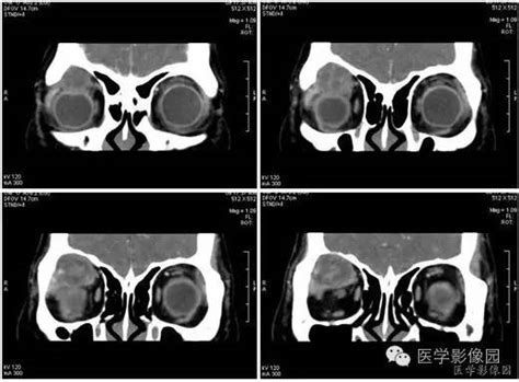 【病例】泪腺混合瘤1例ct影像表现 影像ppt