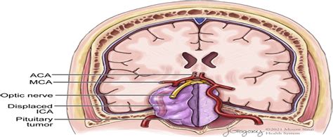 The Knosp Criteria Revisited 3 Dimensional Volumetric Analy Neurosurgery