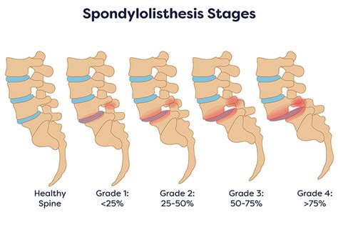 Spondylolisthesis Treatment Nj