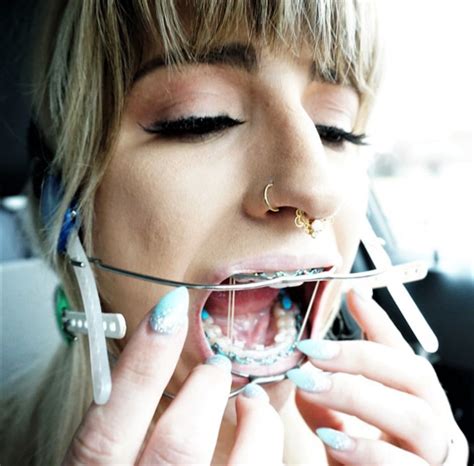 Real Braces Just For Fun