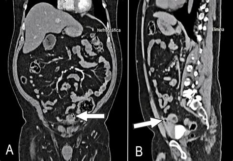 Laparoscopic Umbilicus Sparing Excision Of Symptomatic Patent Urachus