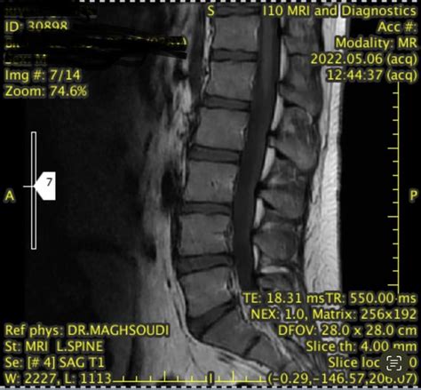 My Recovery Story Disc Herniation L5 S1 L4 L5 And Ddd L3 L4 R Sciatica