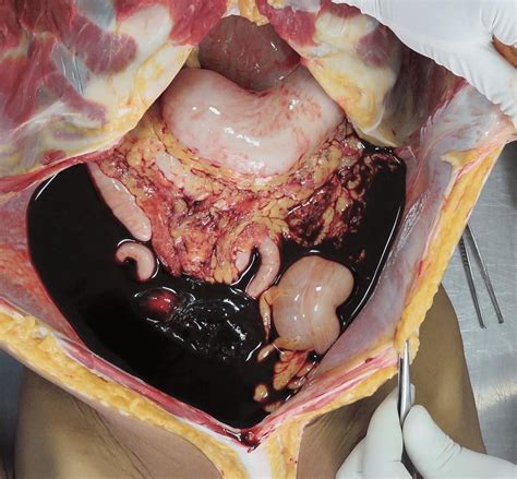 Ruptured Ectopic Pregnancy Causes Sudden Death In 25 Year Old Patient