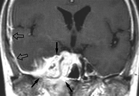 Cavernous Sinus Mri Cavernous Sinus Syndrome Clinical Features And