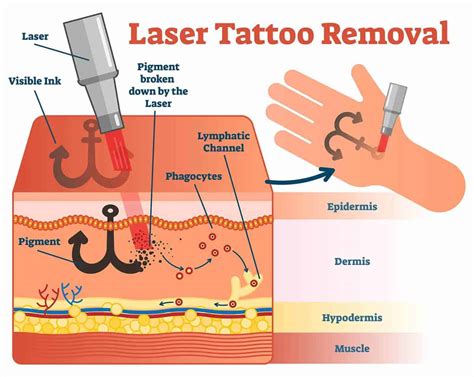 How Does Laser Tattoo Removal Work Goodbye Tattoos