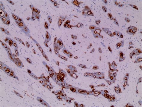 Epithelial Membrane Antigen Ema Labex