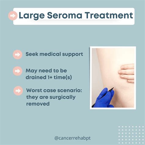 Seroma After Surgery What It Is And What To Do Cancer Rehab Pt