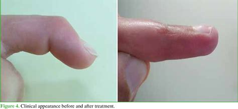 Figure 2 From Tenodermodesis For The Treatment Of Late Presenting