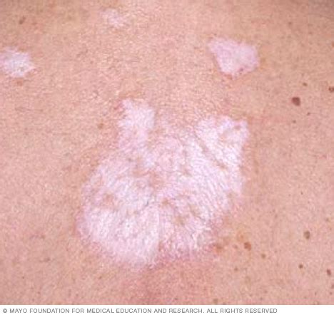 What Causes A Lichen Sclerosus Flare Up