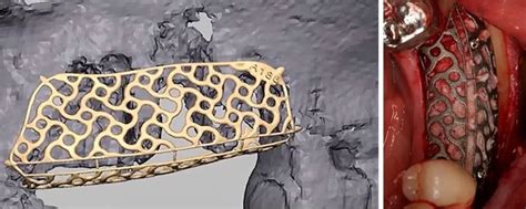 Guided Bone Regeneration Gbr Membrane Part I