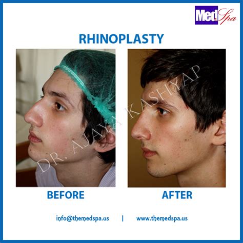 Nose Surgery What To Expect After The Procedure And How It Works