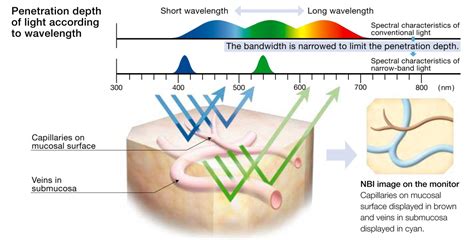 Narrow Band Imaging Nbi — Endoscopic Method For Detection Of Head And