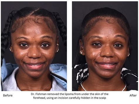 How We Treat Forehead Lipomas And Osteomas At Aviva Plastic Surgery