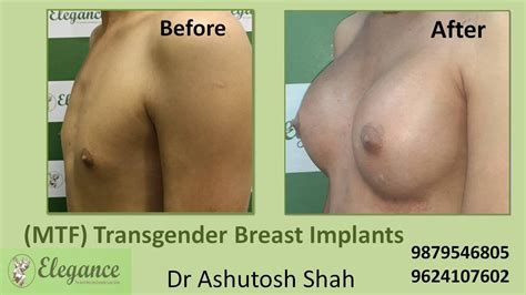 Mtf Breast Augmentation Care In Surat Dr Ashutosh Shah