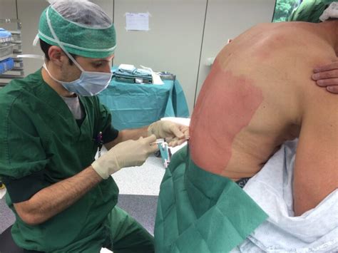 Epidural Anesthesia Nysora