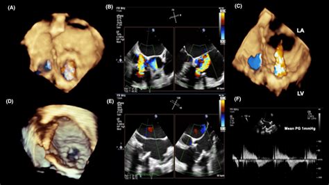 Tee Imaging A 3d‐tee Color Doppler En Face View Shows Severe