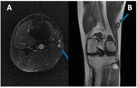Clear Cell Sarcoma Of Soft Tissues Radiological Analysis Of 14