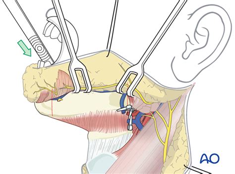 Visor Approach Approach To The Mandible