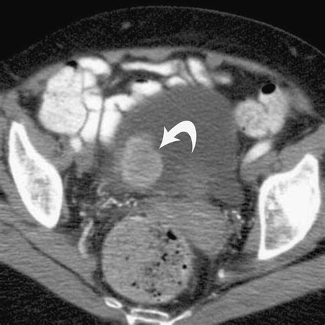 Neoplasms Of The Urinary Bladder Radiologic Pathologic Correlation