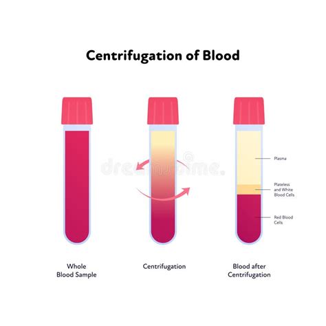 Hemolysis Stock Illustrations 103 Hemolysis Stock Illustrations