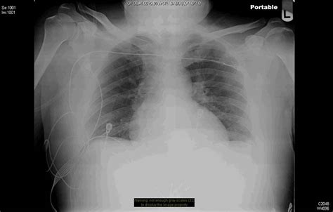 Chest X Ray Findings Myocardial Infarction At Fidel Musselwhite Blog