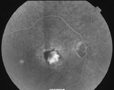 Fluorescein Angiography Confirms Wet Amd The Fluorescent Dye Is Seen