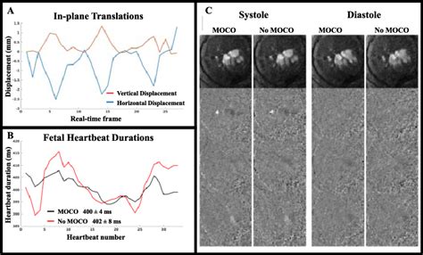 Effects Of Intra Slice Motion Correction Moco In 2d Cine