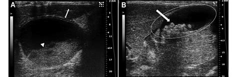 Abdominal Ultrasonography A Gallbladder Contains Echogenic Material