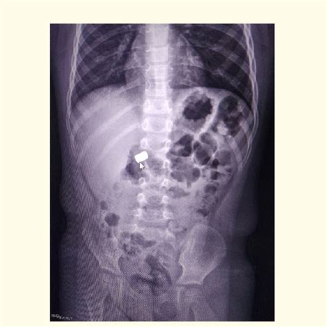 Endoscopic View Of Foreign Objects At Prepyloric Region Of The Stomach