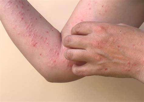 Kemenkes Kasus Cacar Monyet Bertambah Di Indonesia Akibat Sex Berisiko