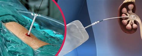 Percutaneous Nephrolithotomy Pcnl