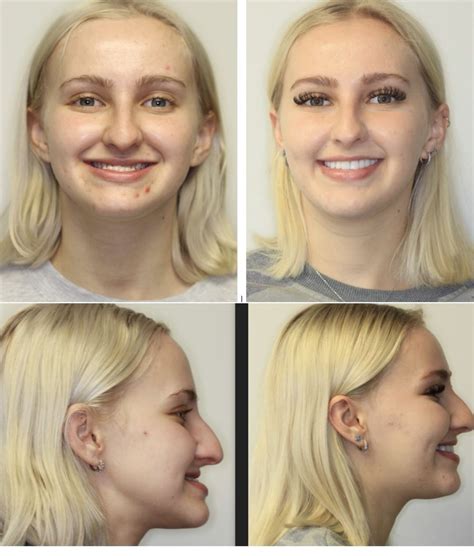 Advanced Dentistry Of Mohegan Lake Mohegan Lake And Tarrytown Ny