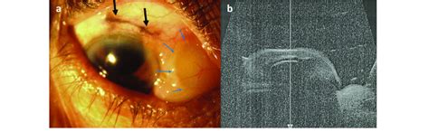 A Clinical Photograph Of The Right Eye At Presentation Showing A