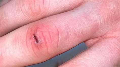 Deep Cut Finger