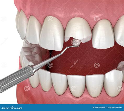 Restoration Of Broken Tooth Medically Accurate 3d Illustration Stock