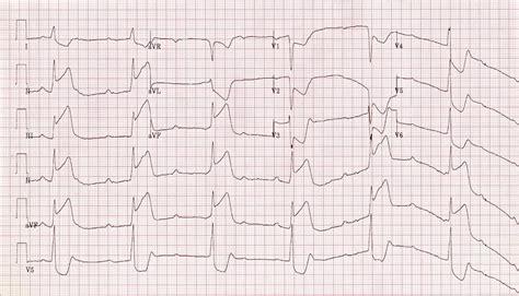 Av Block Ecg Examples At Susan Villanueva Blog