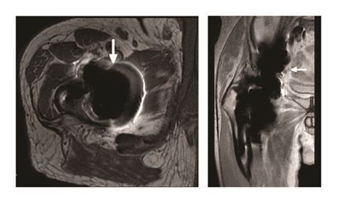 Mars Mri Of The Right Hip With Metal Wear Debris With Comprehensive