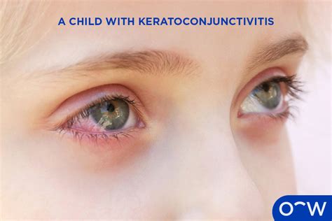 Keratoconjunctivitis Sicca Eye Scleral Lens Society على X Dry Eye