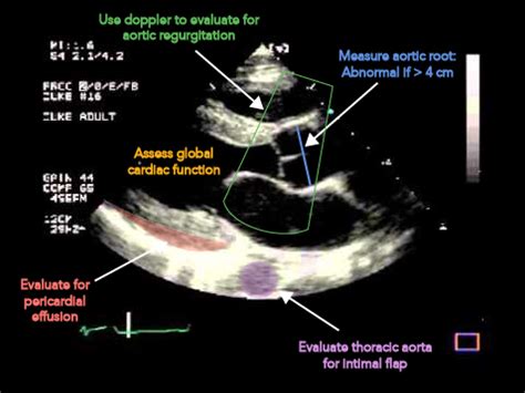 Echocardiography Ucsd Ultrasound