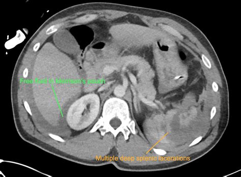 CT Case LITFL CT Scan Interpretation