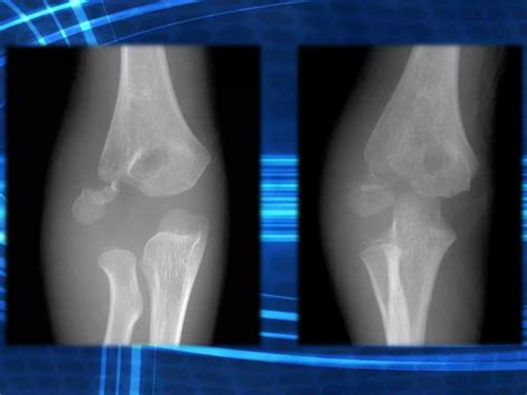 Closed Vs Open Reduction In Lateral Condylar Fractures Of Humerus In