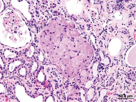 Oncocytic Proliferative Lesion Located In Kidney Cortex That Is Download Scientific Diagram