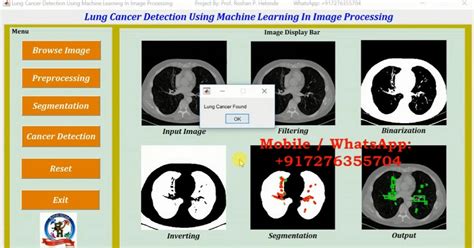 Lung Cancer Detection Using Machine Learning Technique Matlab Project